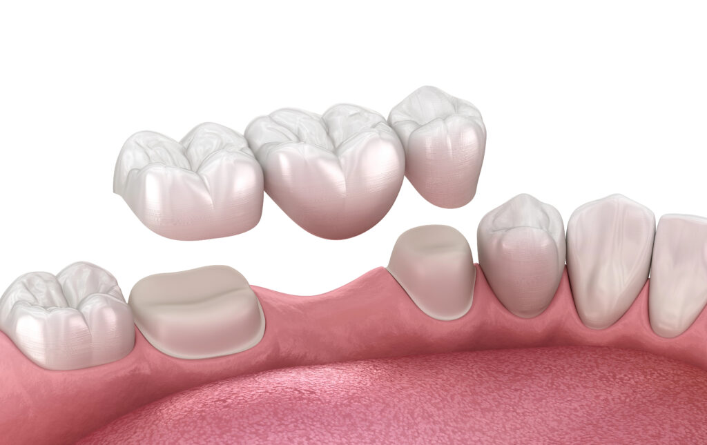 Dental Bridges for Front Teeth: Seamless Results for a Natural Look ...